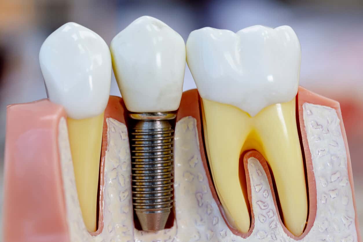 Comment se déroule la pose d’implants dentaires? - St-Onge Dental Center